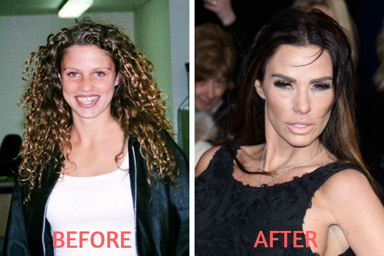Katie Price Veneers Before And After At Jo Perez Blog Katie Price Veneers Before And After At Jo Perez Blog